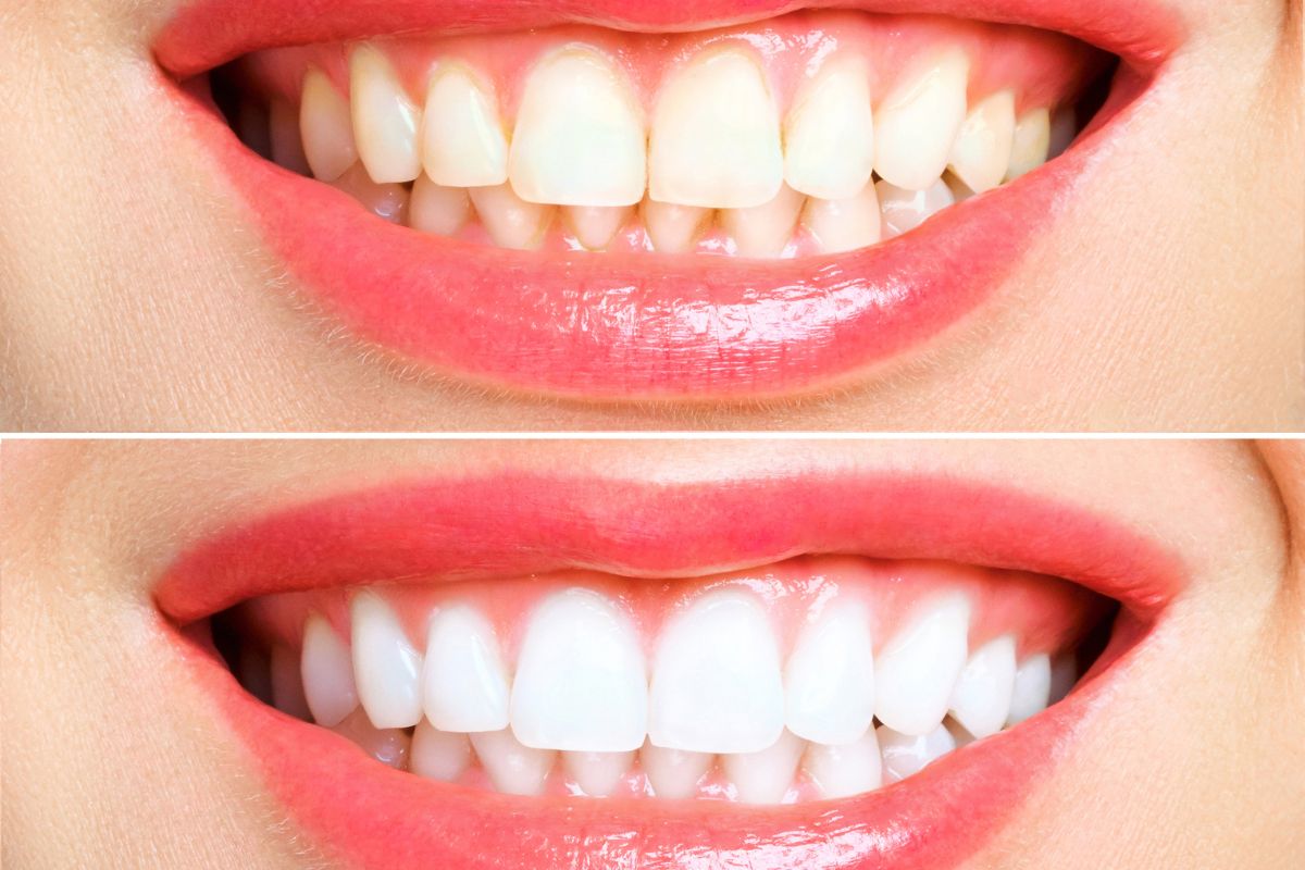 Do Teeth Whitening Strips Work? Pros and Cons
